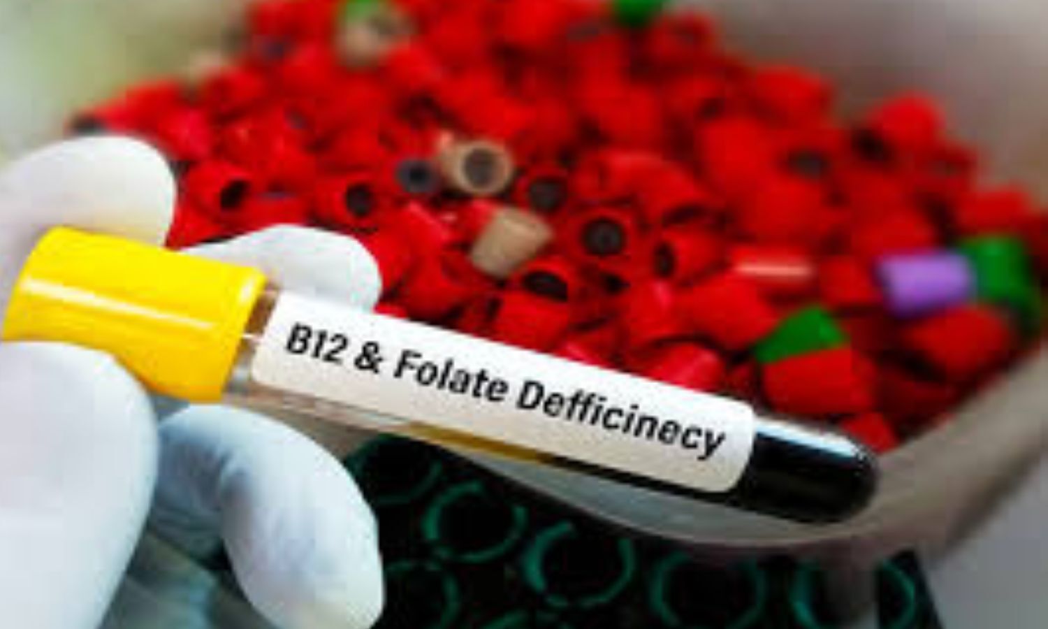 Vitamin B12, folate deficiencies could be related with fatigue, reduced ...